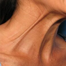 Nefertiti Neck Lift - Neck Bands - foreveryoungaestheticsclinic